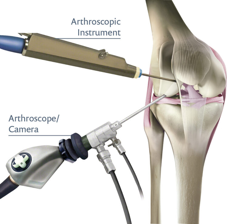 Knee Arthroscopy Perth Dr Daniel Fick