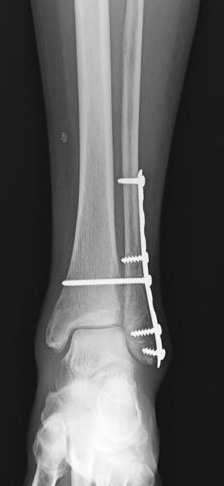Fracture Fixation Surgery Perth | Dr Daniel Fick