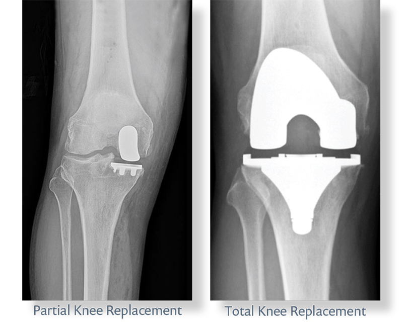 Unicompartmental Partial Knee Replacement Surgery Perth Unicompartmental Partial Knee Replacement Surgery Perth