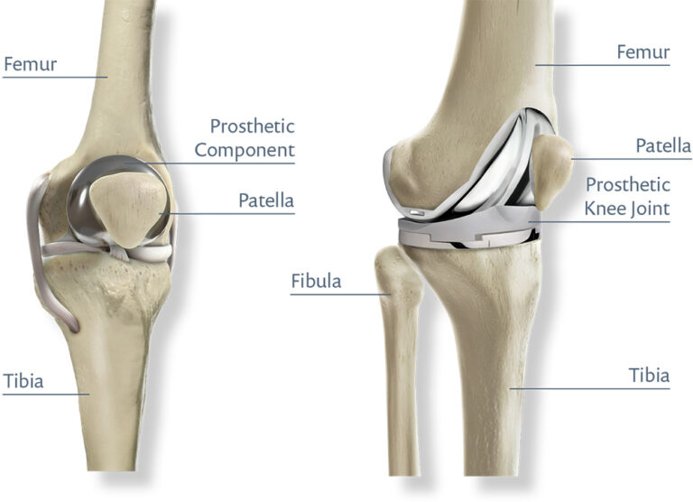 Patellofemoral Partial Knee Replacement Perth | Daniel Fick